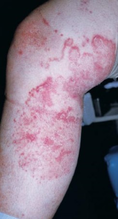 Why isn't this rash responding to over the counter creams? | Consultant360