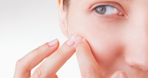 Which Contraceptives Improve Acne the Most? | Consultant360