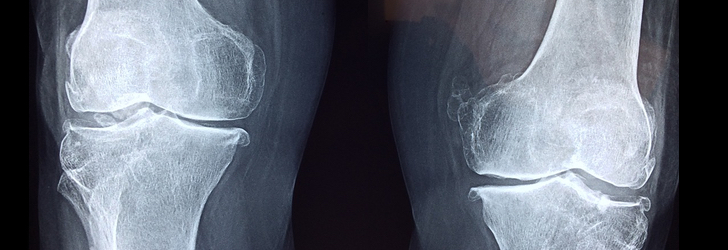Weight Loss Method Affects Knee Cartilage Deterioration | Consultant360