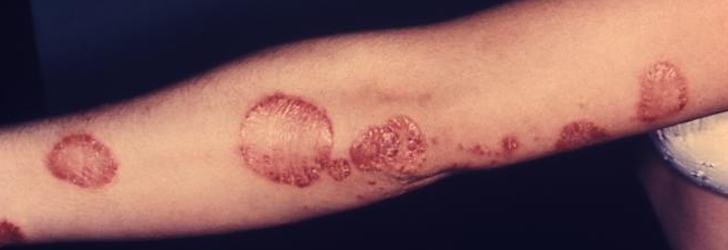 JAK Inhibitor Shows Long-term Efficacy for Plaque Psoriasis | Consultant360