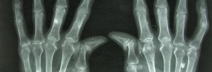 Ultrasound Successfully Diagnoses Hand Synovitis | Consultant360