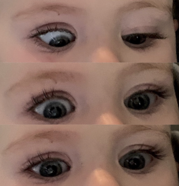 Ptosis and Rhythmic Eye Movement in a Young Child | Consultant360