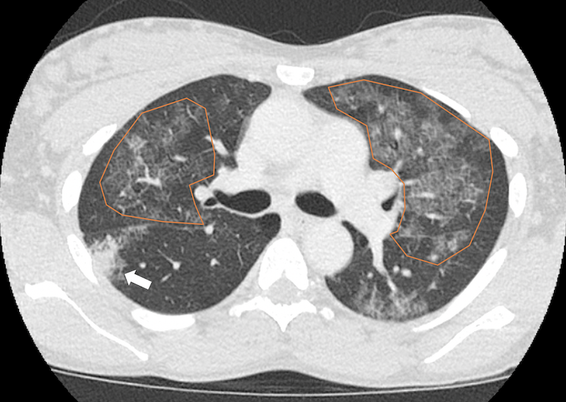 Chylothorax and Respiratory Failure Following Spontaneous Vaginal ...