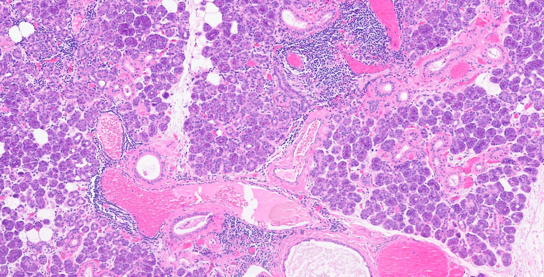 Abnormally Large Submandibular Salivary Gland Sialolithiasis ...