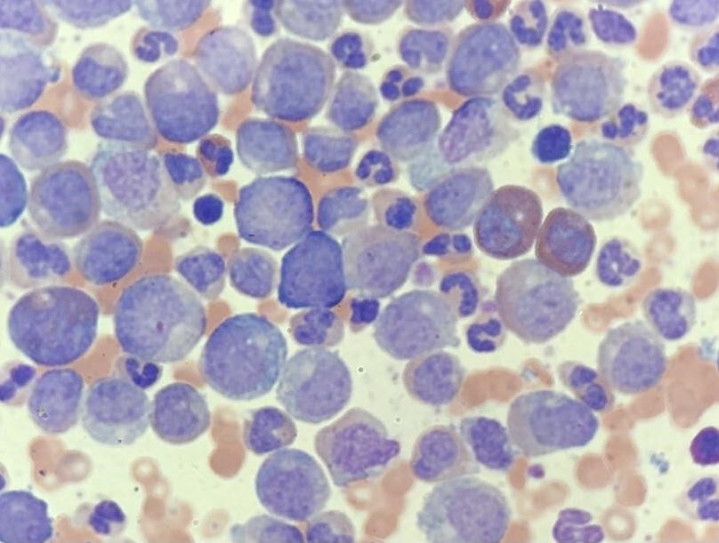 Newly Diagnosed Chronic Myeloid Leukemia With Leukostasis | Consultant360