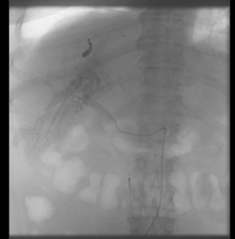 Hereditary Hemorrhagic Telangiectasia as a Cause of Portal Hypertension ...