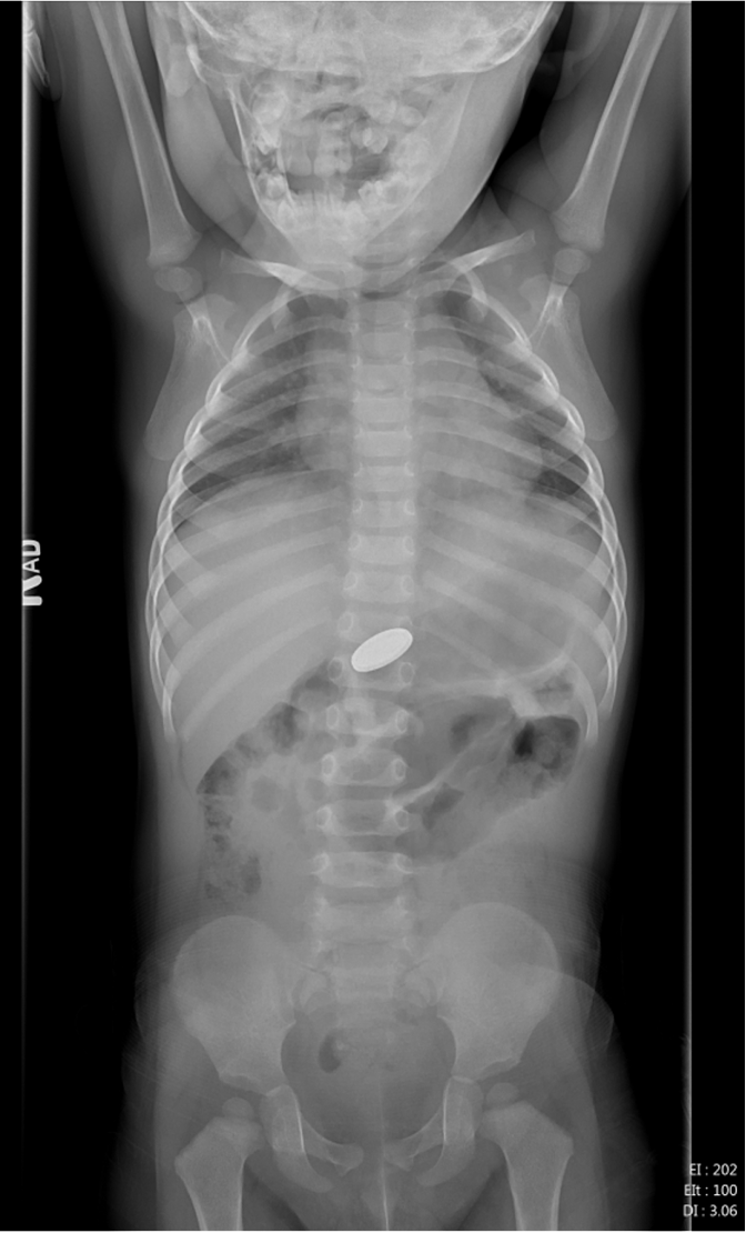Early Recognition and Management of Lithium Battery Ingestion in a 15 ...