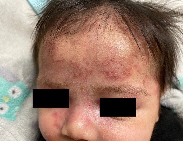 Ring Rash in an Infant: Unmasking Neonatal Lupus | Consultant360