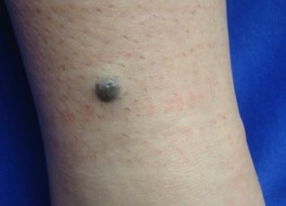 An Atlas of Lumps and Bumps, Part 43: Blue Nevi | Consultant360