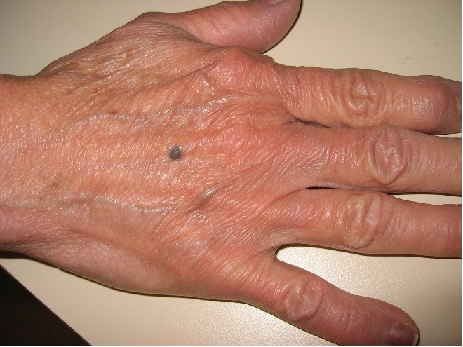 An Atlas of Lumps and Bumps, Part 43: Blue Nevi | Consultant360