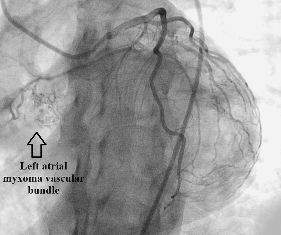 Unmasking the Culprit of PVCs: Left Atrial Myxoma Diagnosed ...