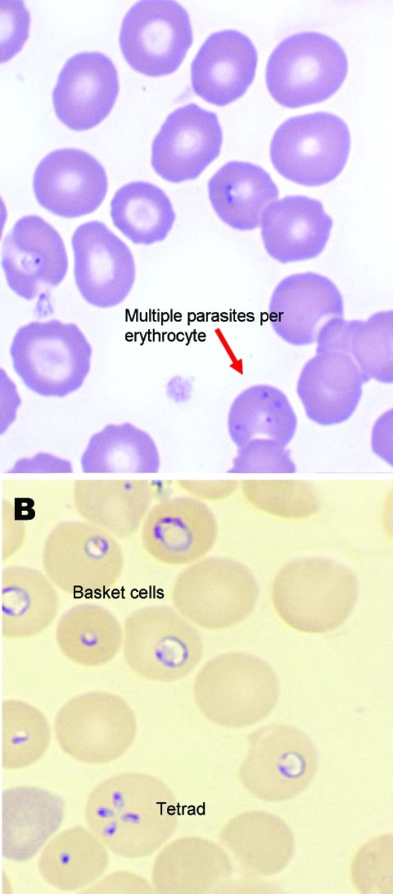 Neonate With Acquired Babesiosis | Consultant360