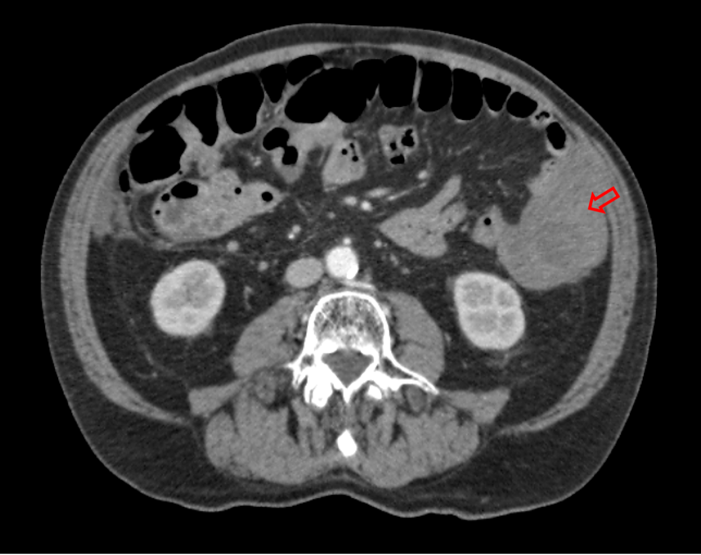 From Routine to Rare: Splenic Injury Following Colonoscopy | Consultant360