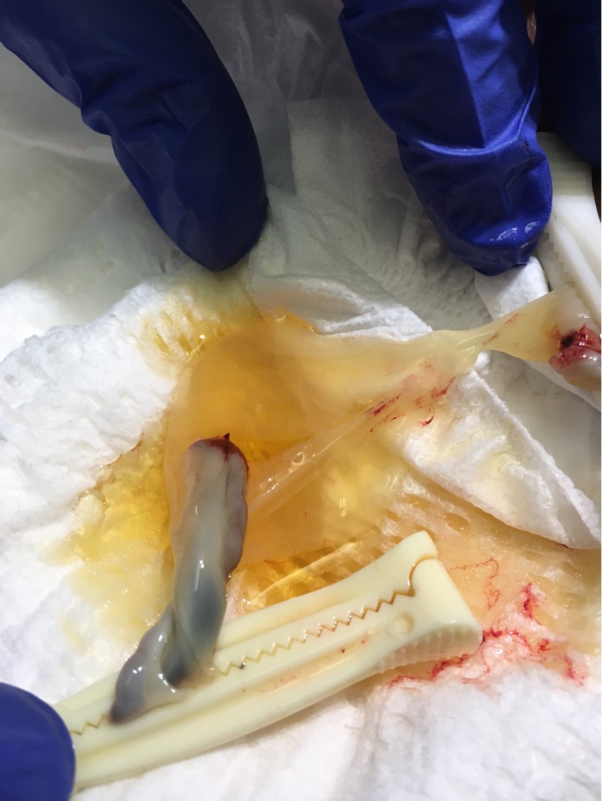 A Unique Presentation of Umbilical Cord Pseudocyst | Consultant360