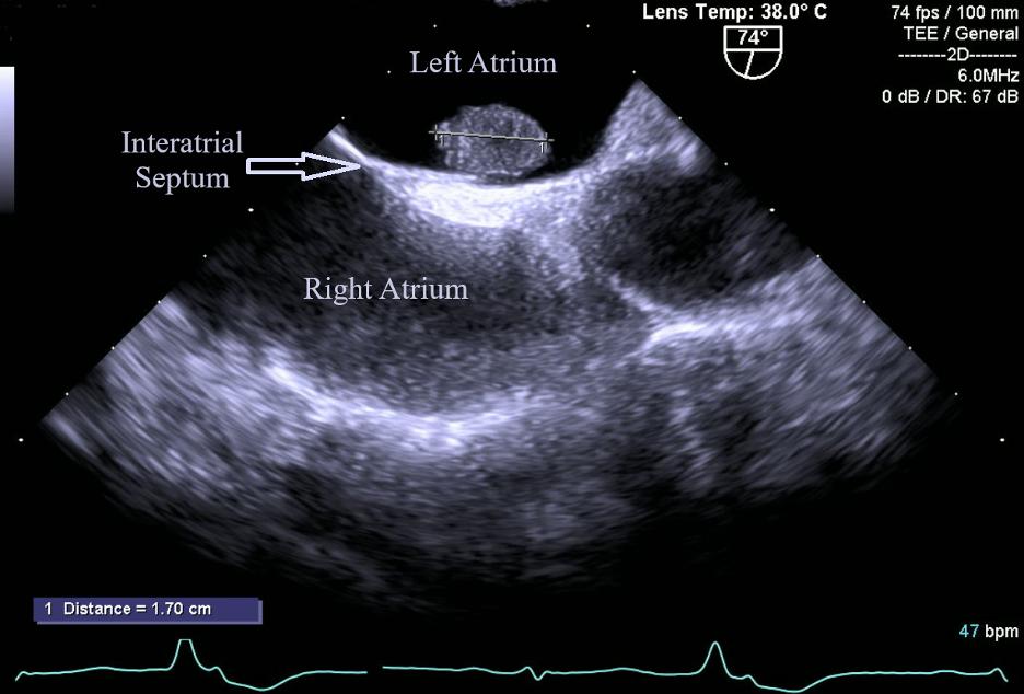 Unmasking the Culprit of PVCs: Left Atrial Myxoma Diagnosed ...