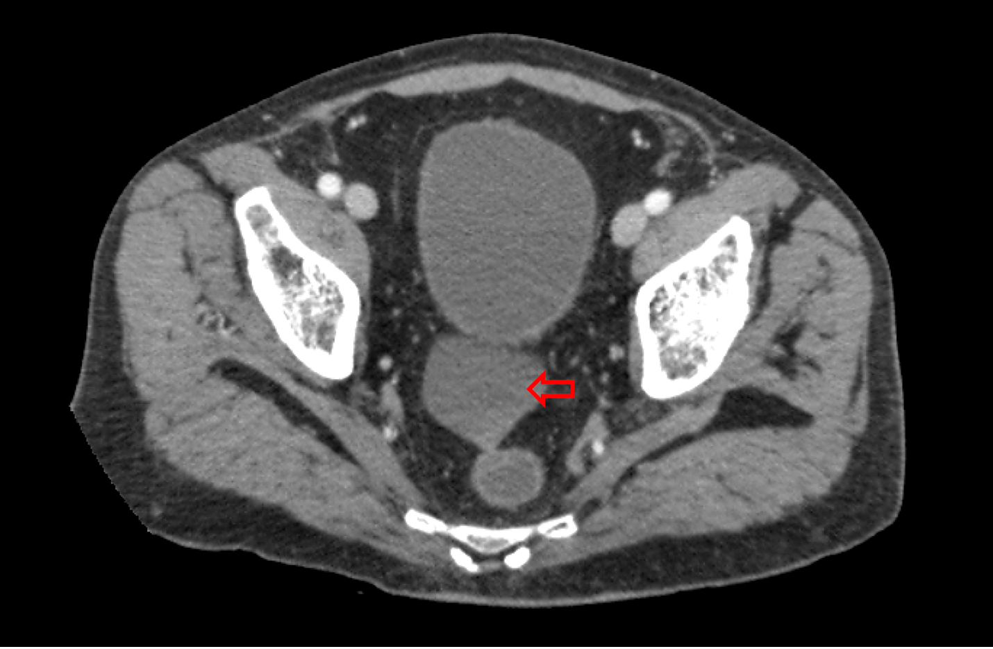 From Routine to Rare: Splenic Injury Following Colonoscopy | Consultant360