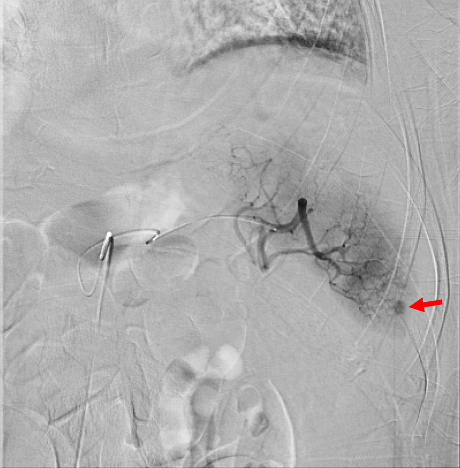 From Routine to Rare: Splenic Injury Following Colonoscopy | Consultant360