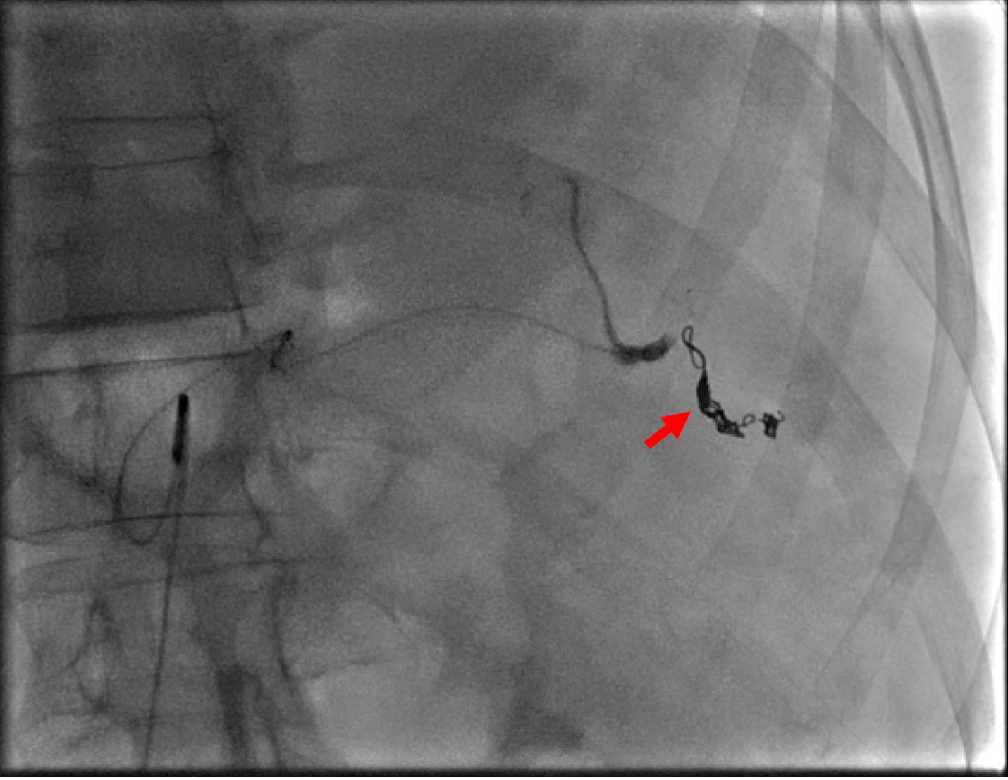 From Routine to Rare: Splenic Injury Following Colonoscopy | Consultant360
