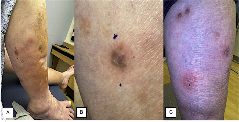 Mycobacterium Chelonae Infection Diagnosed by PCR in a Patient with ...