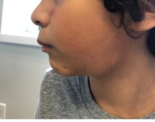 Submandibular Lymph Node Swelling About Swollen Lymph Nodes Behind The
