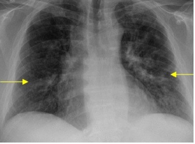 Daptomycin-Induced Eosinophilic Pneumonia in a Rural Setting ...