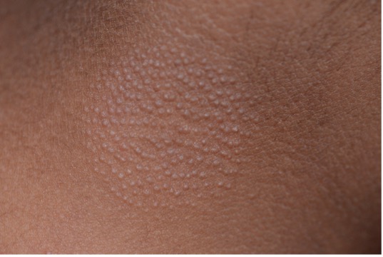 An Atlas of Lumps and Bumps, Part 39: Lichen Spinulosus | Consultant360