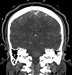 Iatrogenic Pneumocephalus, Intracranial Hypotension, and Cerebral ...