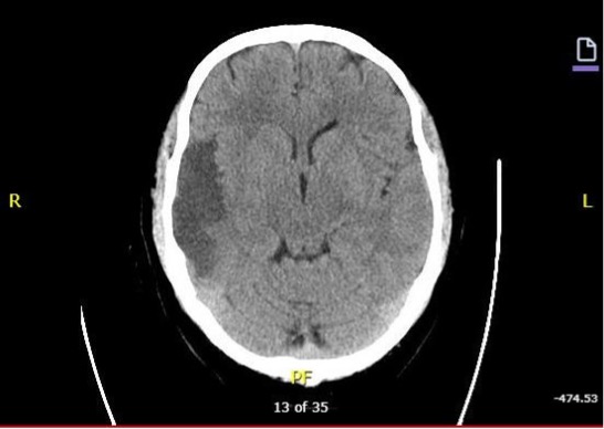 Atypical Presentation of a Subacute Temporal Infarct | Consultant360