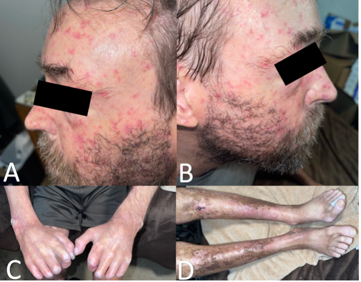 Seronegative Atypical Diffuse Systemic Sclerosis | Consultant360