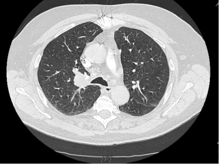 A Rare Case Report on Radiation Recall Pneumonitis in a Patient Treated ...