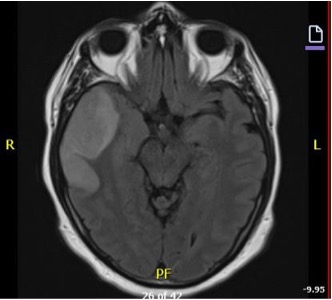 Atypical Presentation of a Subacute Temporal Infarct | Consultant360