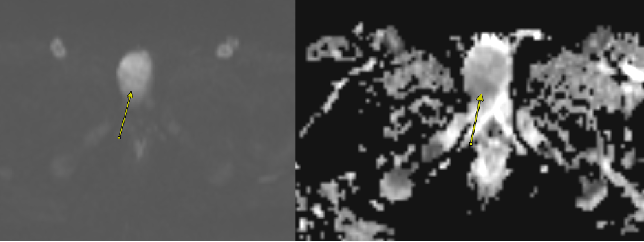 A Rare Extra-Gonadal Sac Tumor Presenting as a Labial Mass in a Child ...