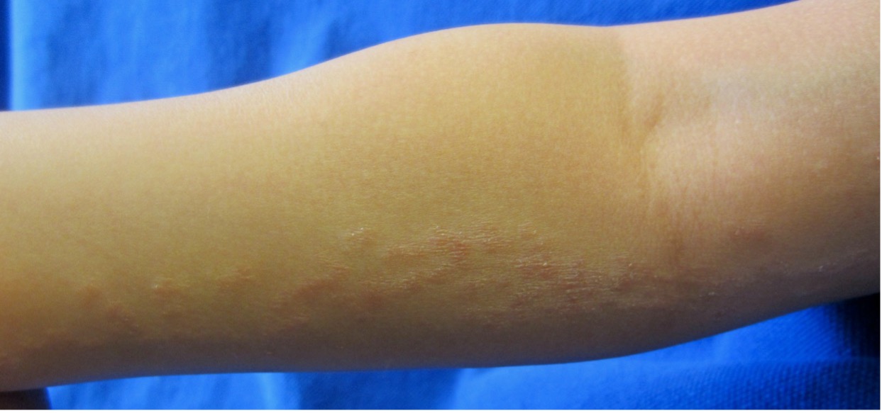 An Atlas of Lumps and Bumps, Part 38: Lichen Striatus | Consultant360