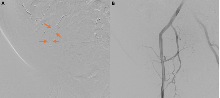 Endovascular Stent Placement for Transplant-Related Arterio-Enteric ...