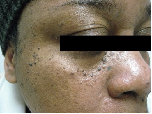 An Atlas of Lumps and Bumps, Part 44: Dermatosis Papulosa Nigra ...