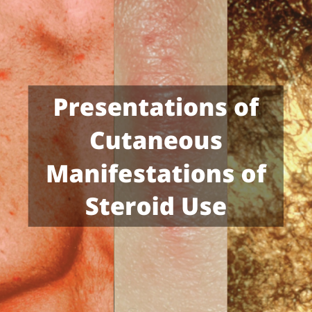 Slideshow: Presentations of Cutaneous Manifestations of Steroid Use