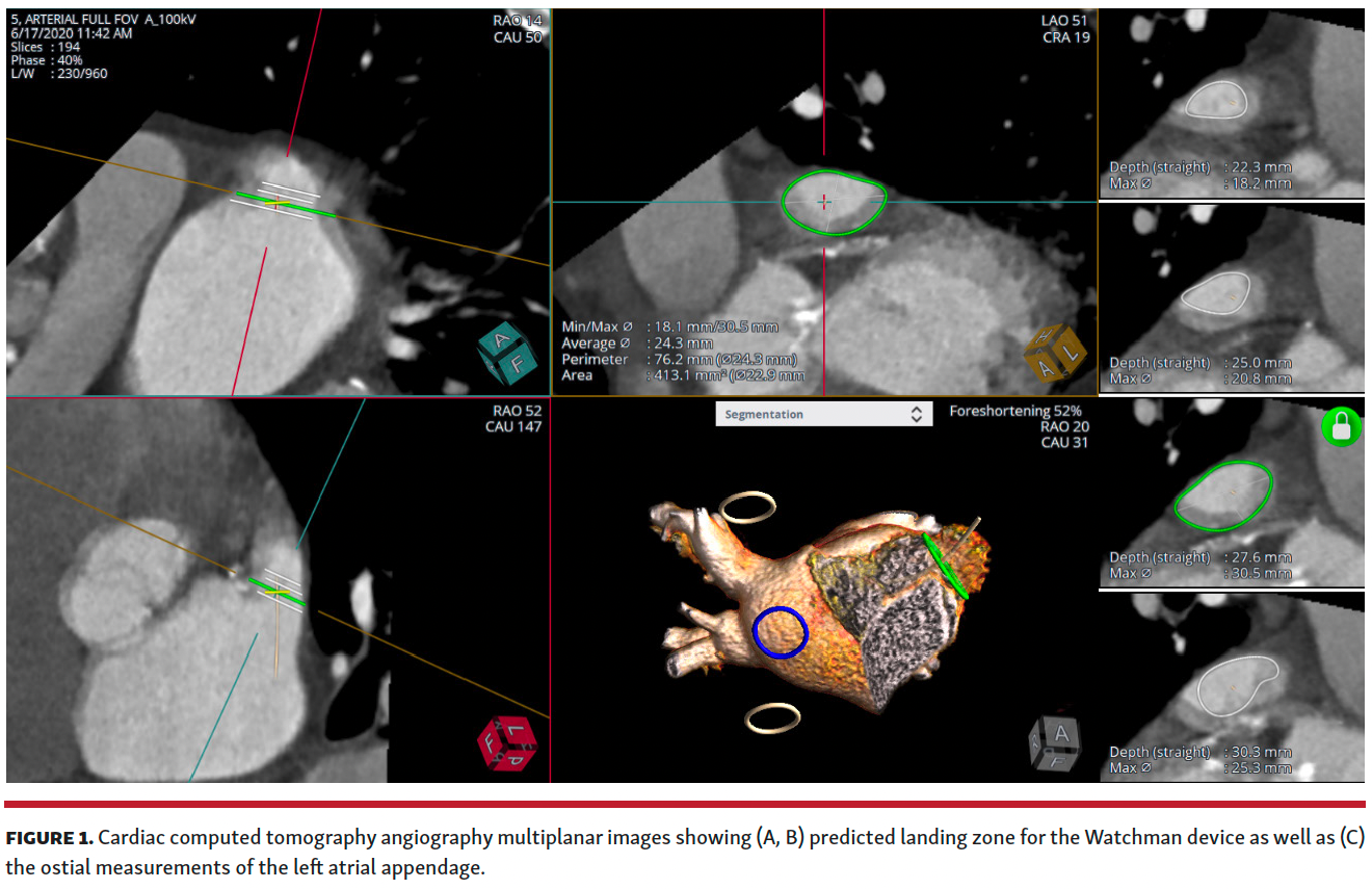 Study: LAAO using Cardiac CTA & Intracardiac Echocardiography