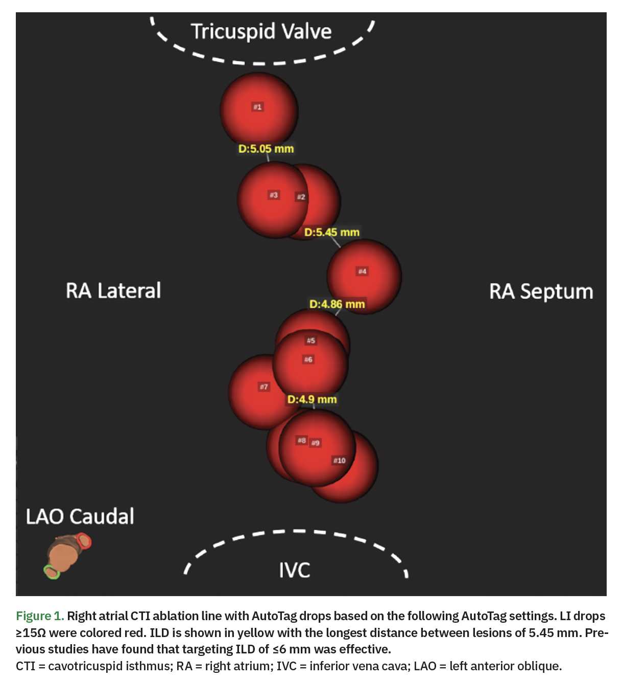 Case Study: Local Impedance Guided Cavotricuspid Isthmus (CTI ...