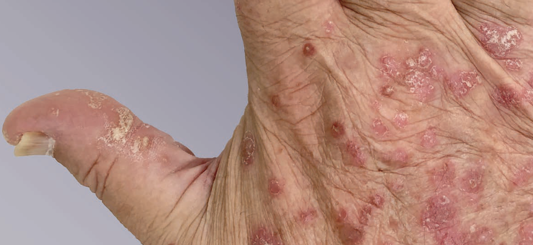 Trivia: Treating Localized Psoriasis