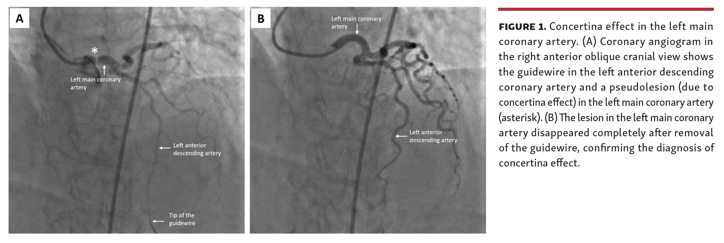 A Phantom Lesion in the Left Main Coronary Artery: Concertina Effect