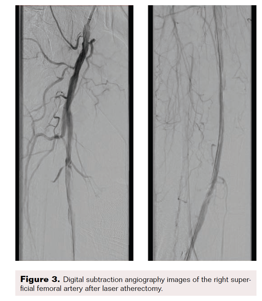Arterial Sheath Management | Vascular Disease Management