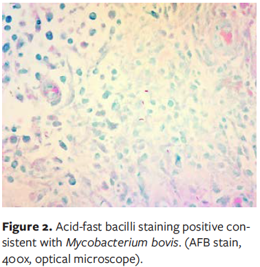 Development of Chancre-Variant Cutaneous Tuberculosis After BCG Vaccine ...