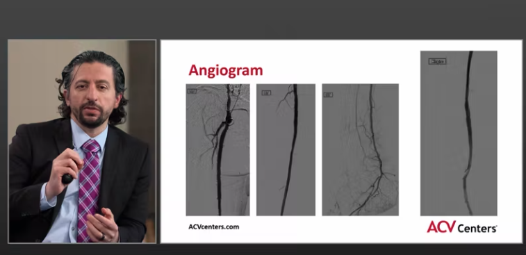 Philips Tack Endovascular System for Flow-Limiting Dissection | CLD