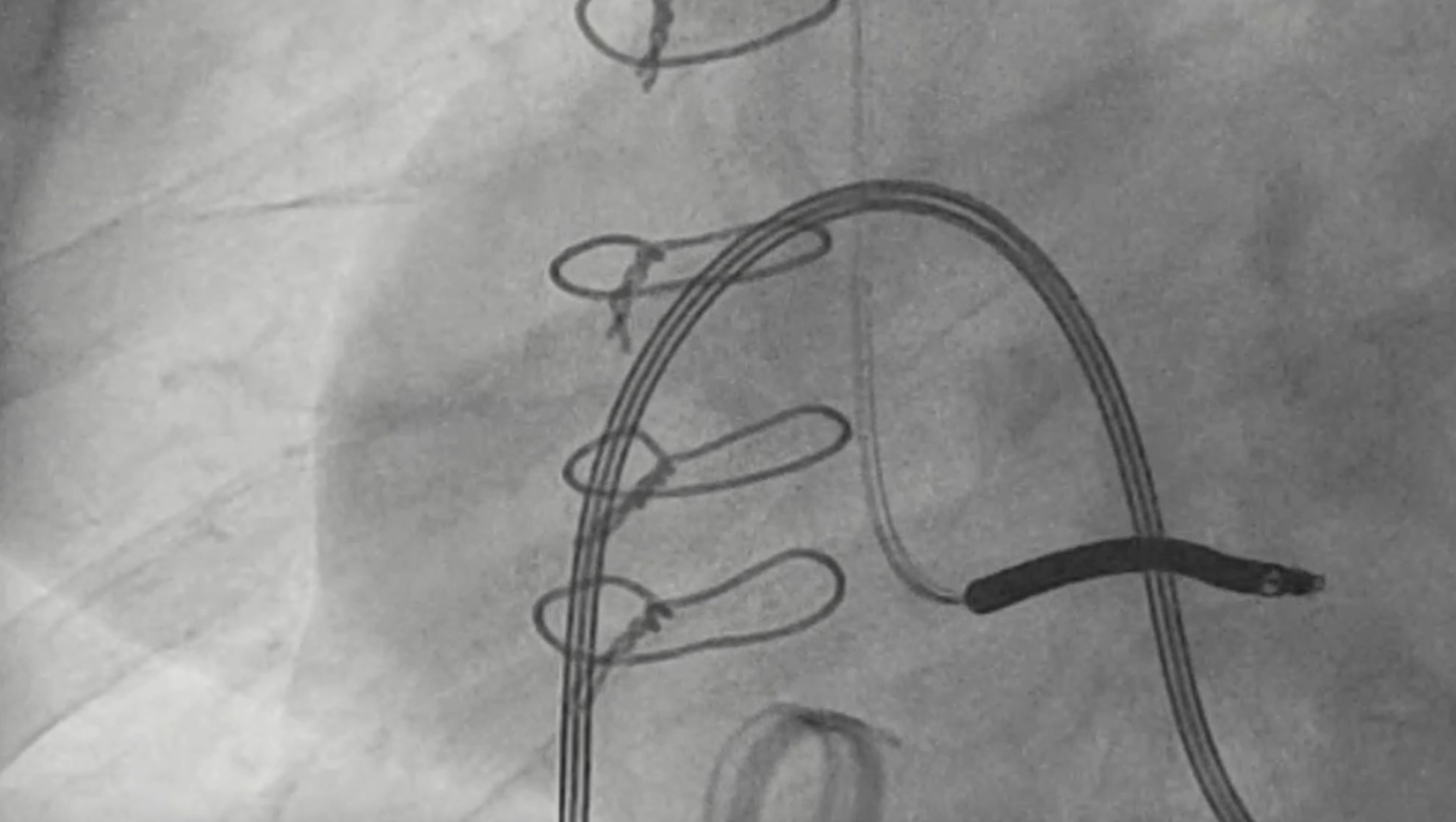 Percutaneous Treatment of Symptomatic LVAD Outflow Graft Obstruction