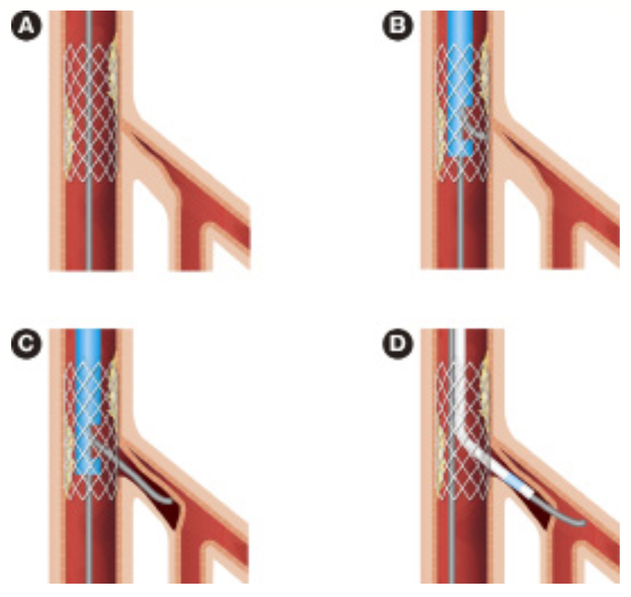 Subintimal Tracking and Re-entry Technique for Stent-Jailed Side-Branch ...