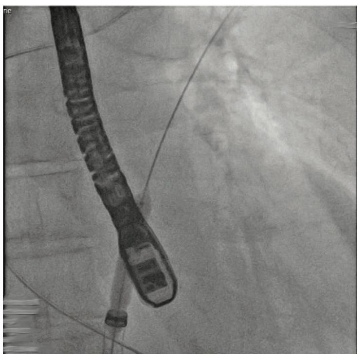 Transseptal Access Using Balloon-Assisted Tracking Technique | CLD