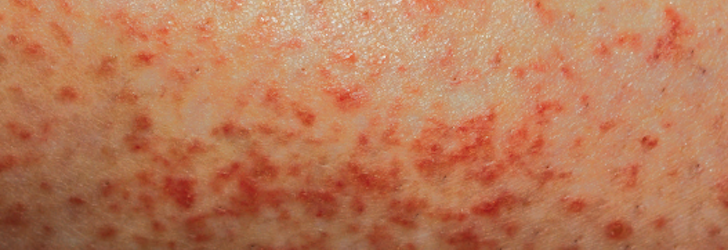 What’s New and Hot in Atopic Dermatitis?