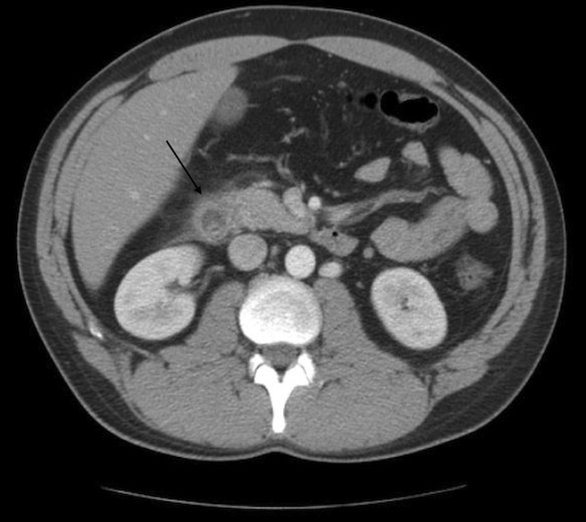 Pancreatitis Caused by Campylobacter Enteritis