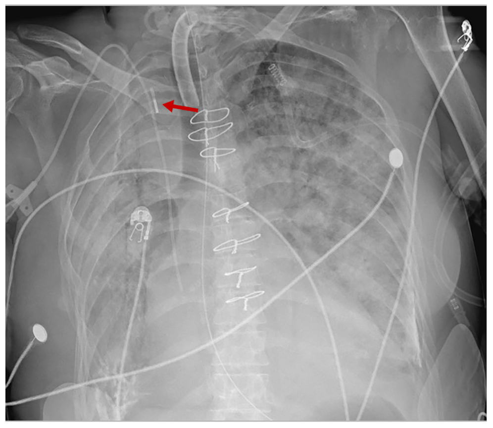Intra Aortic Balloon Pump Xray