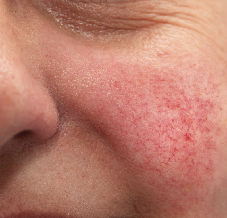 Highlights of Rosacea Research 2022